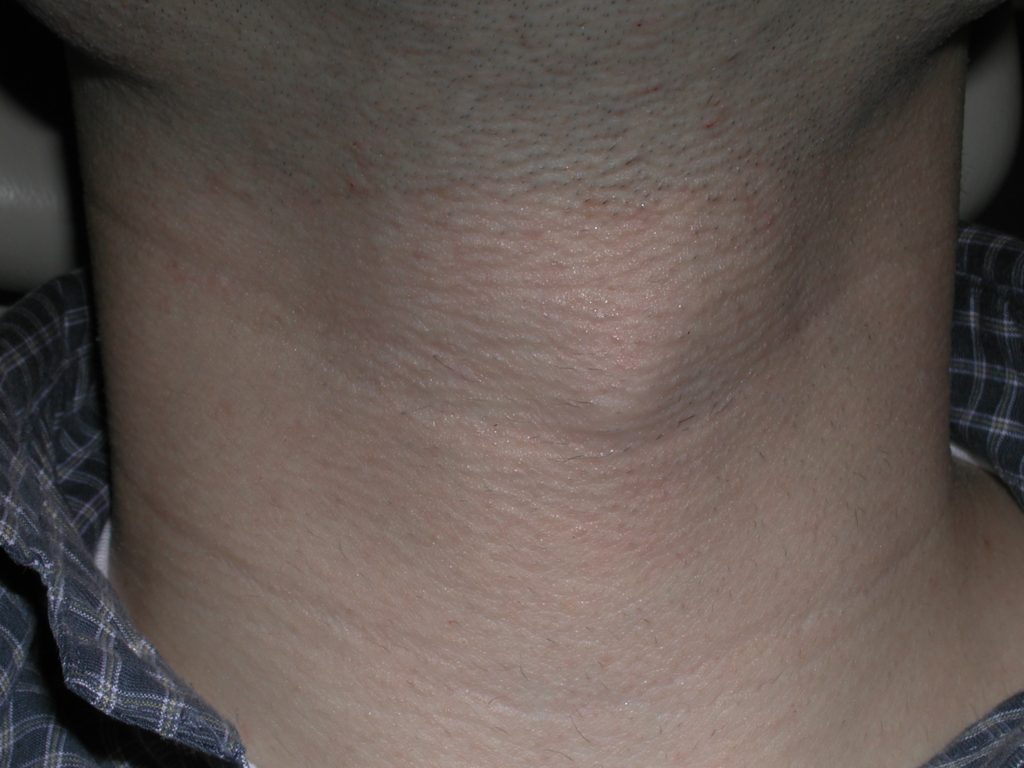 Laser Hair Removal | The Cosmetic & Skin Surgery Center