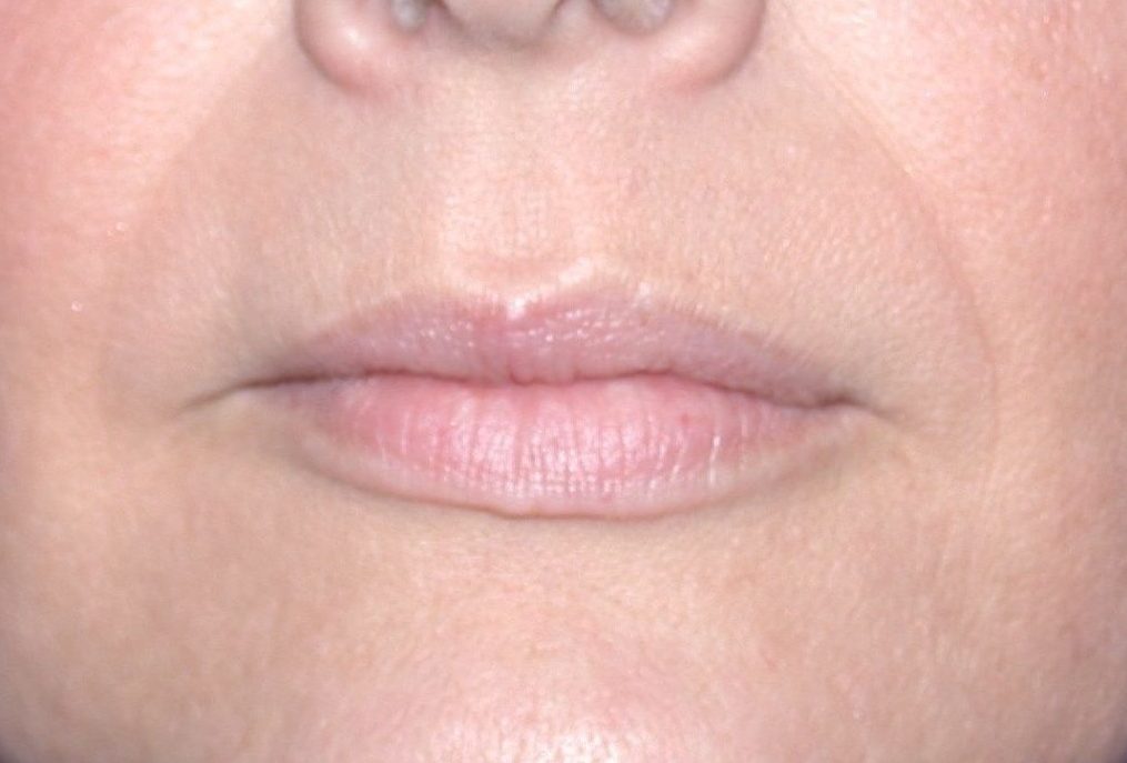 Juvederm® - The Cosmetic and Skin Surgery Center