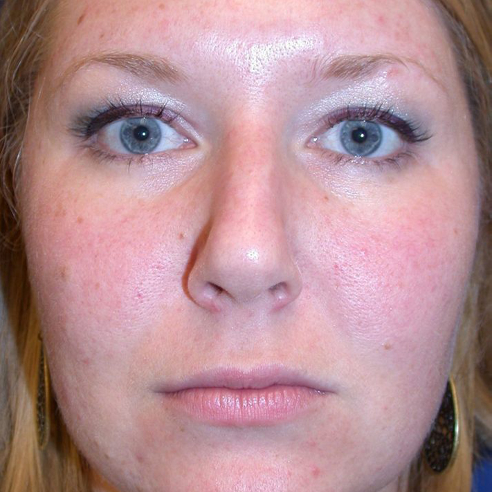 Ultherapy® - The Cosmetic and Skin Surgery Center