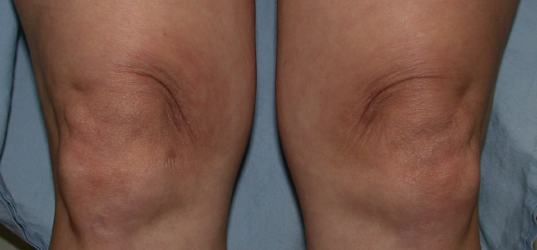 PRP (Platelet Rich Plasma) Cosmetic Treatments - The Cosmetic and Skin ...