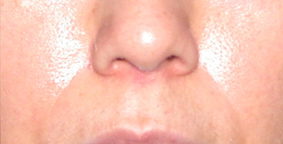 PRP (Platelet Rich Plasma) Cosmetic Treatments - The Cosmetic and Skin ...