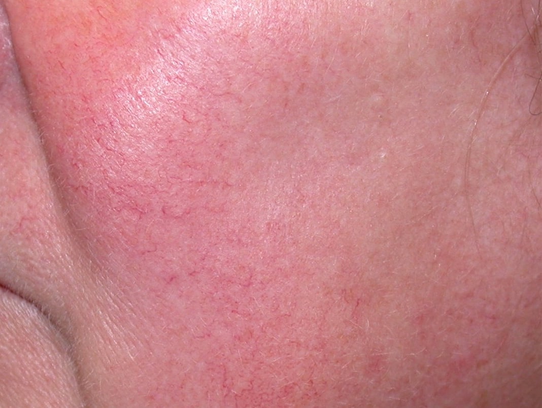 Anti-Redness & Rosacea Therapy - The Cosmetic and Skin Surgery Center