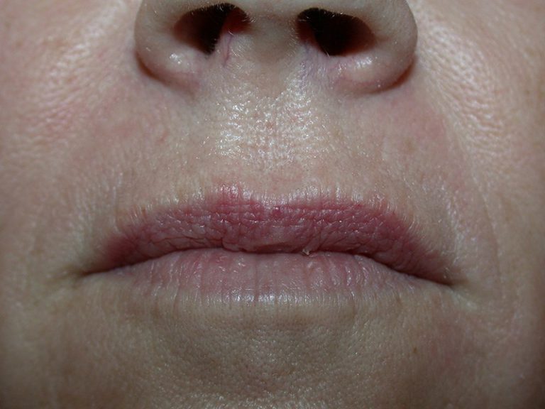 Ultherapy® - The Cosmetic and Skin Surgery Center